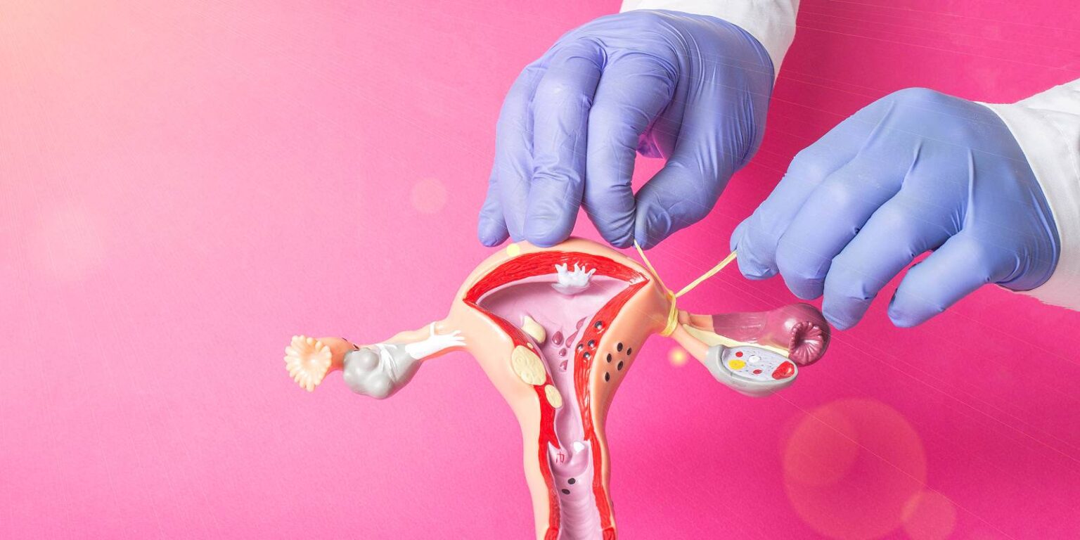 What is Tubectomy? It is a method for women to avoid pregnancy...